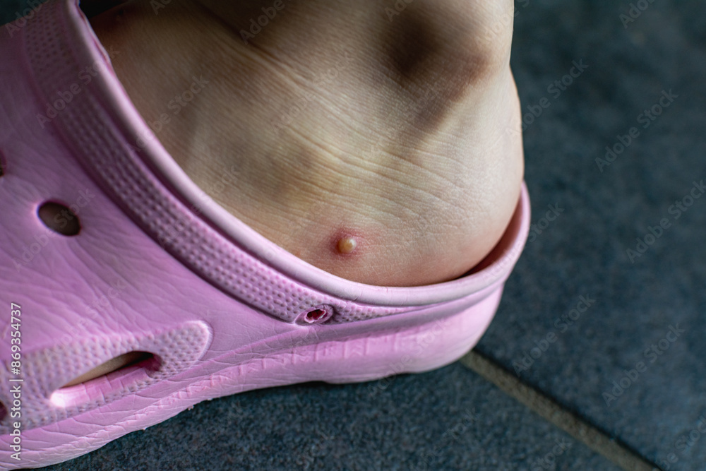 Child with chickenpox spots, childhood illness caused by the varicella ...