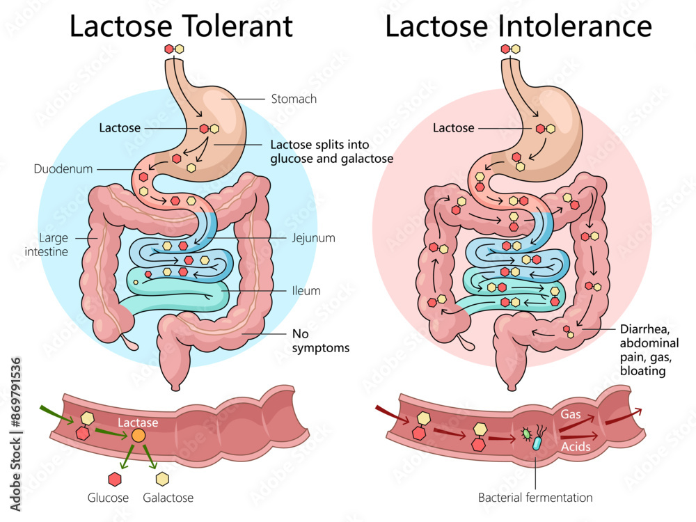Plakát lactose tolerance and intolerance in the digestive system, illustrating symptoms and ...