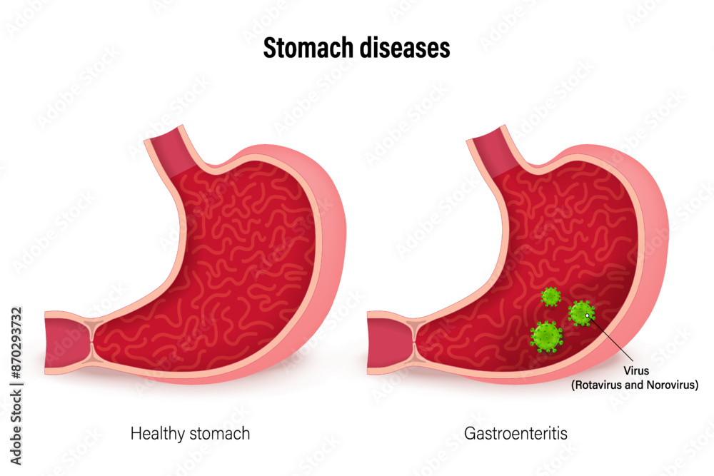 Stomach diseases. Comparison of healthy stomach and gastroenteritis ...