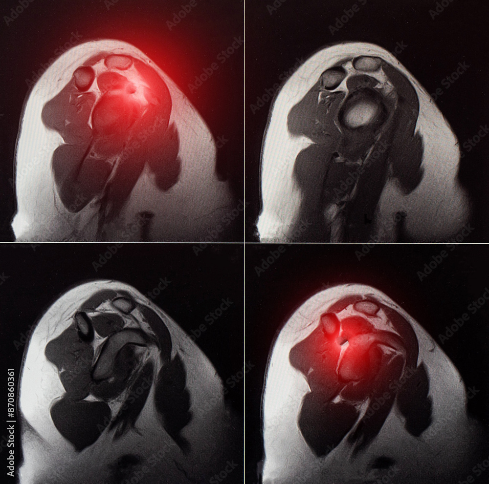 MRI image of the shoulder joint after a fracture and dislocation ...