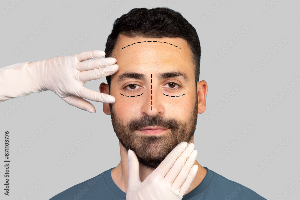 Man with pencil marks on skin for plastic surgery, ready for operation ...