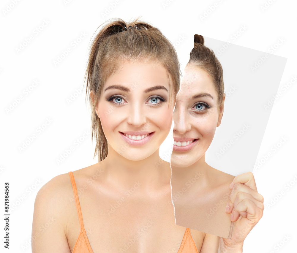 Skin problems .. Before- After,Portrait of beautiful girl with problem ...