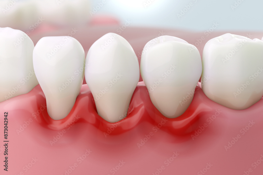 Poster Gum disease and inflammation from Periodontitis. 3D rendering ...