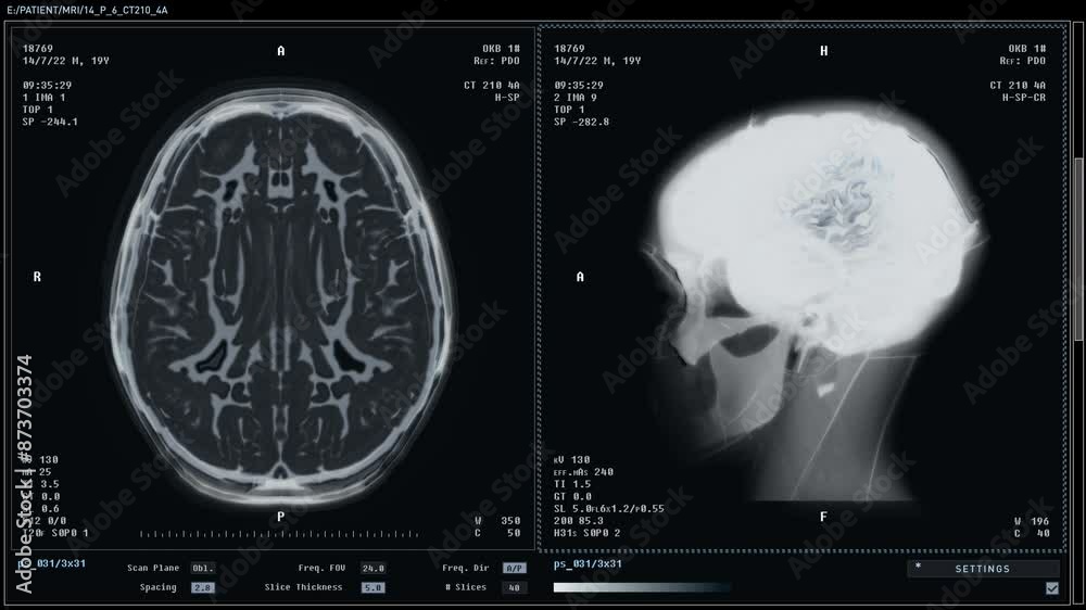 Modern X-Ray Scanning Human Skull To Examine Brain Damage. Medical ...