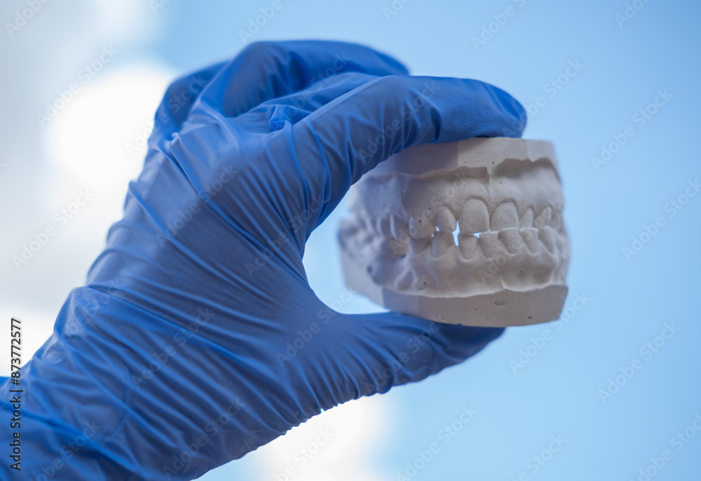 White plaster impression of the dental jaw of a patient with crooked ...