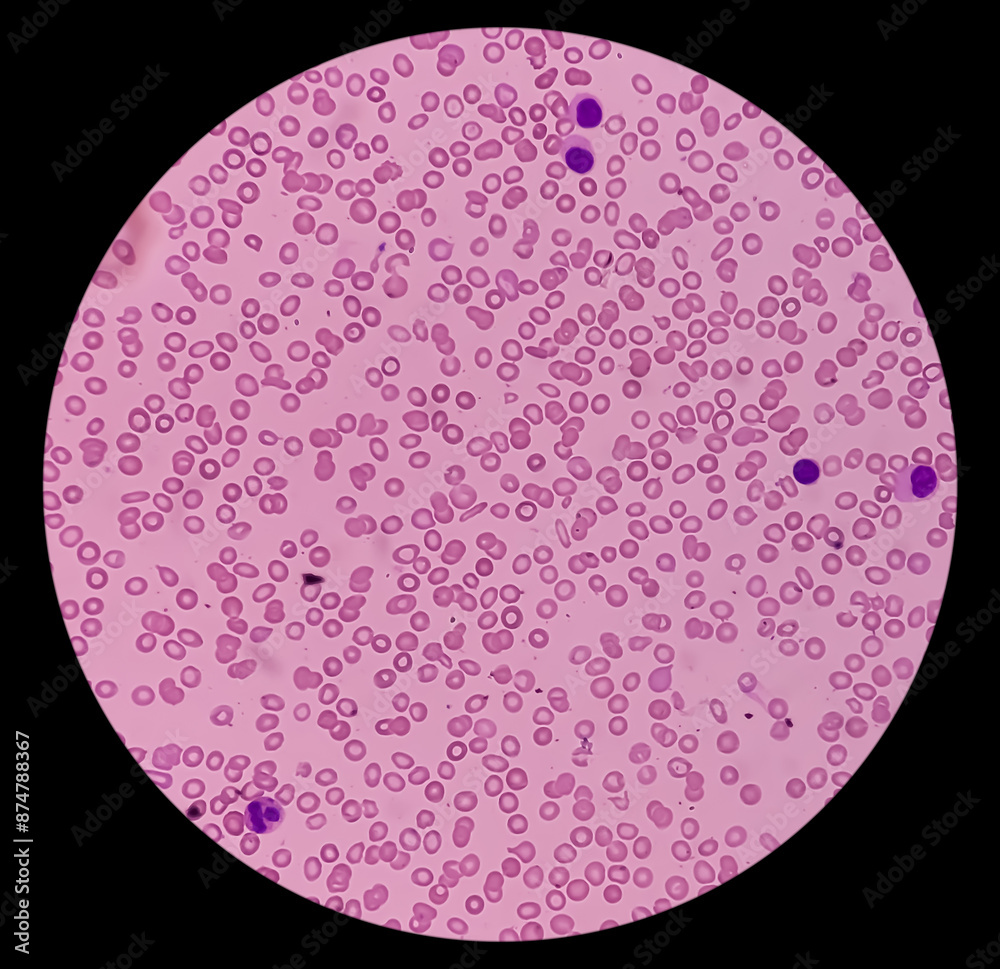 PBF (peripheral blood film): Blood smear thalassemia showing ...