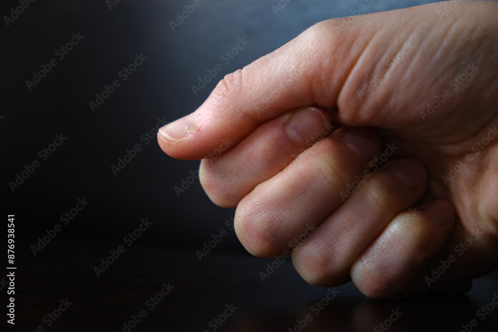 Bleeding hangnail of a female hand on dark background close-up. Ill ...