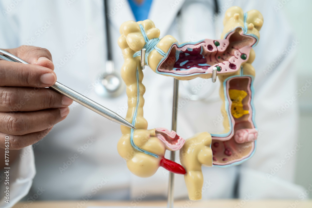 Ulcerative Colitis. Intestine, appendix and digestive system, doctor ...