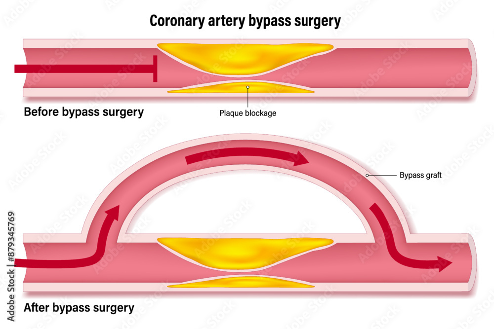 Poster Coronary artery bypass of the human heart – Wall Art | UkPosters