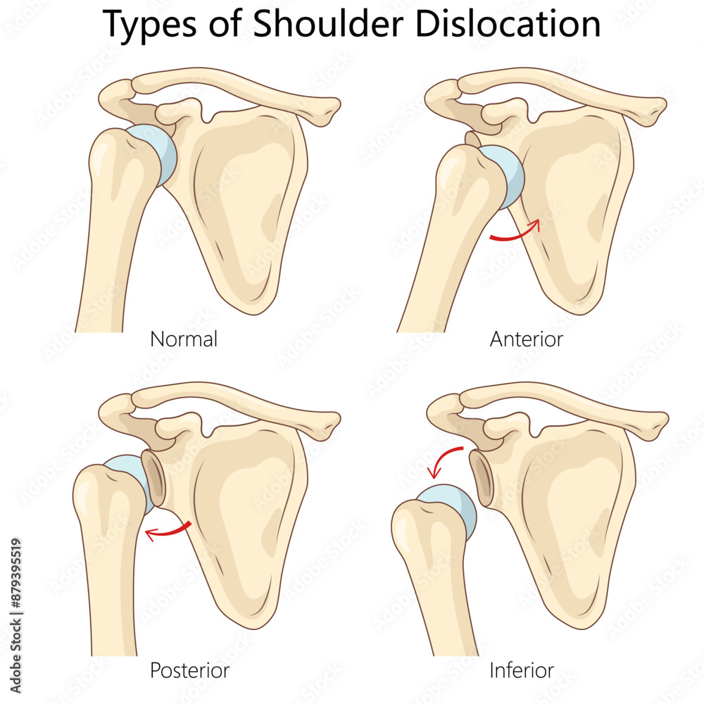 types of shoulder dislocation, normal, anterior, posterior, inferior dislocations, positions of ...