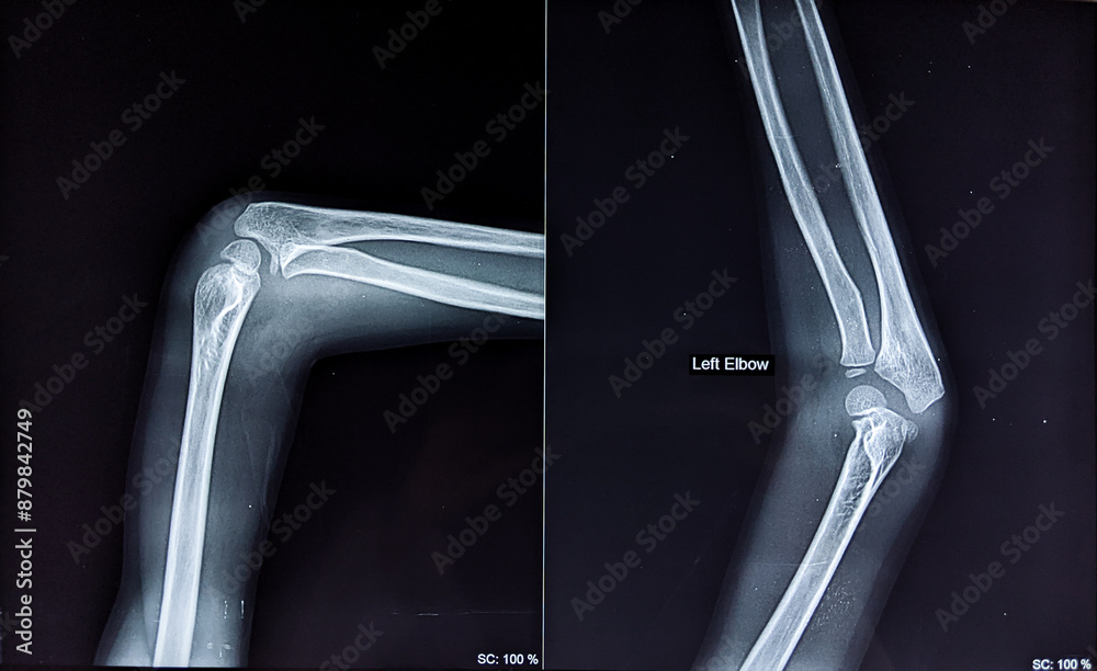 X ray of elbow joint showing lateral condyle fracture of humerus, a ...