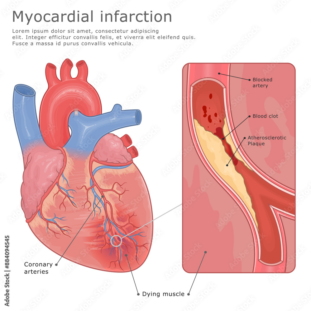 Myocardial infarction medical vector illustration. Human heart and ...