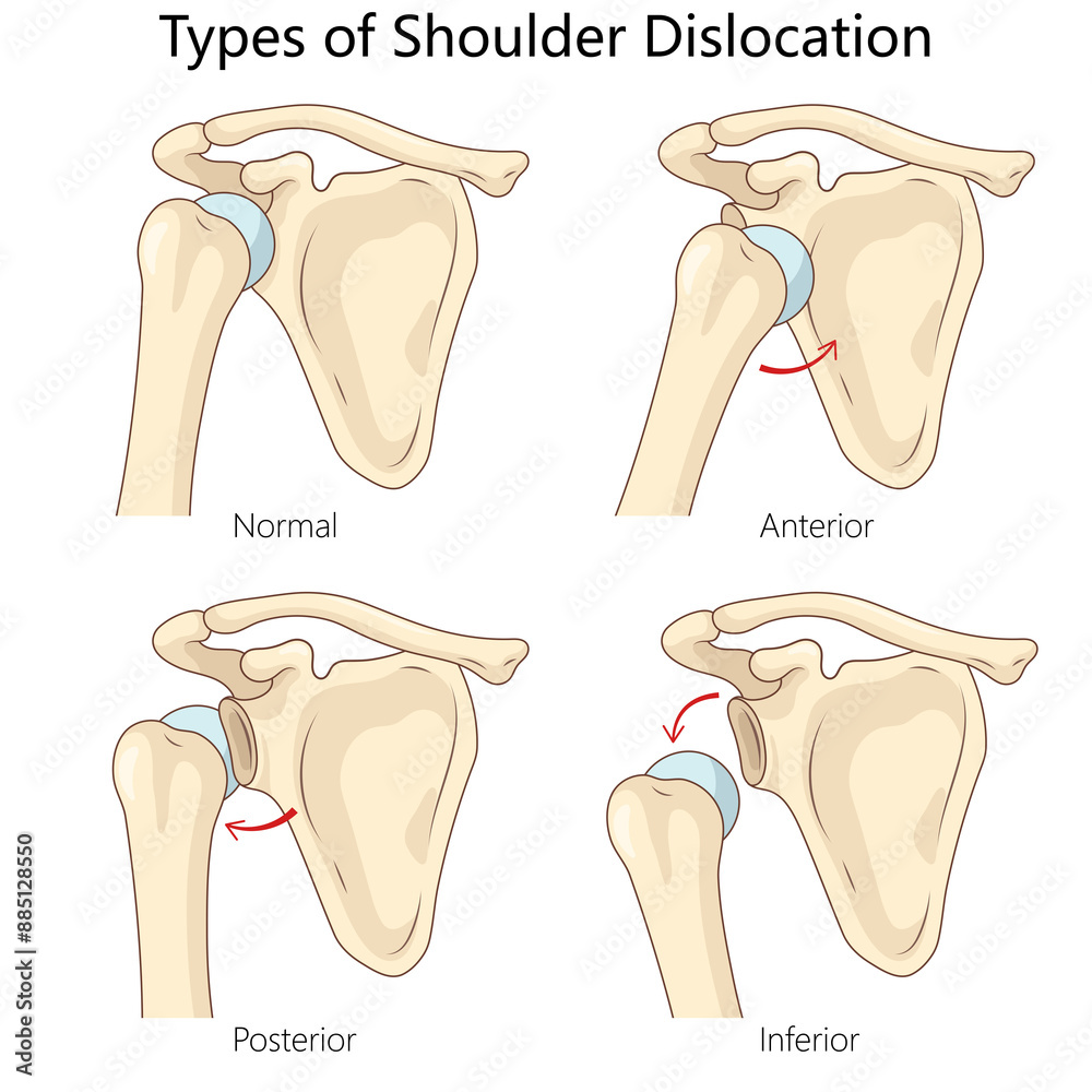 Types Of Shoulder Dislocation Normal Anterior Posterior Inferior Dislocations Positions Of