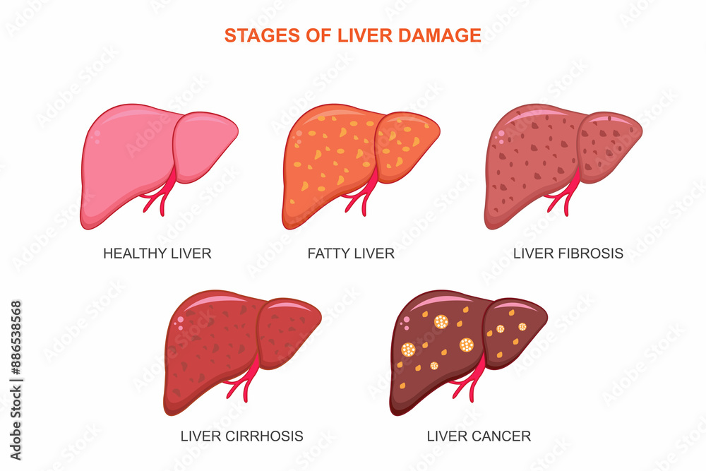 Stages of Liver damage.Fatty liver, cirrhosis and liver cancer on white ...