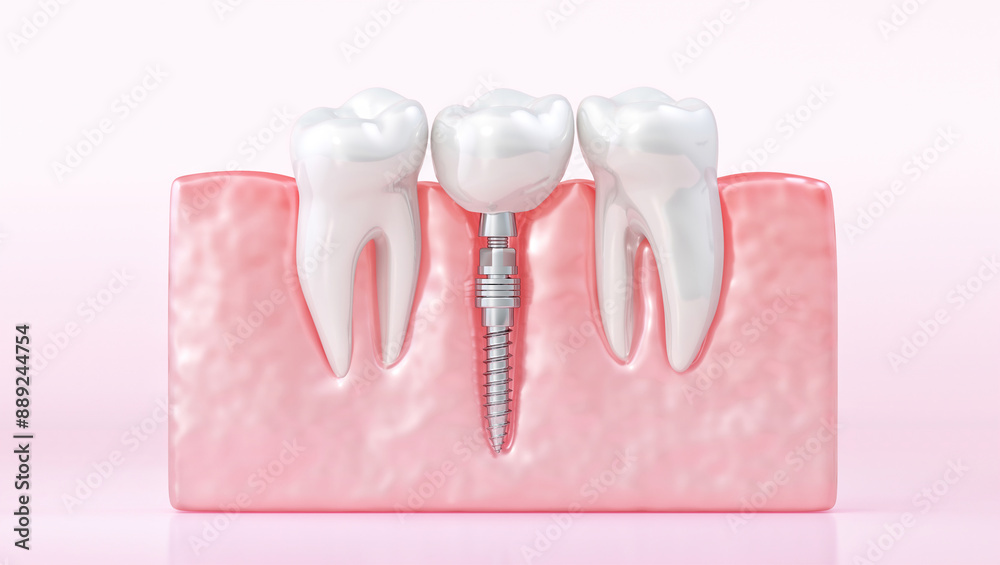 Teeth implant. Placement of a titanium implant into the jawbone to ...