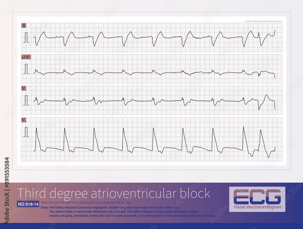 A patient with AIMI presents with a sudden widening of the QRS complex ...