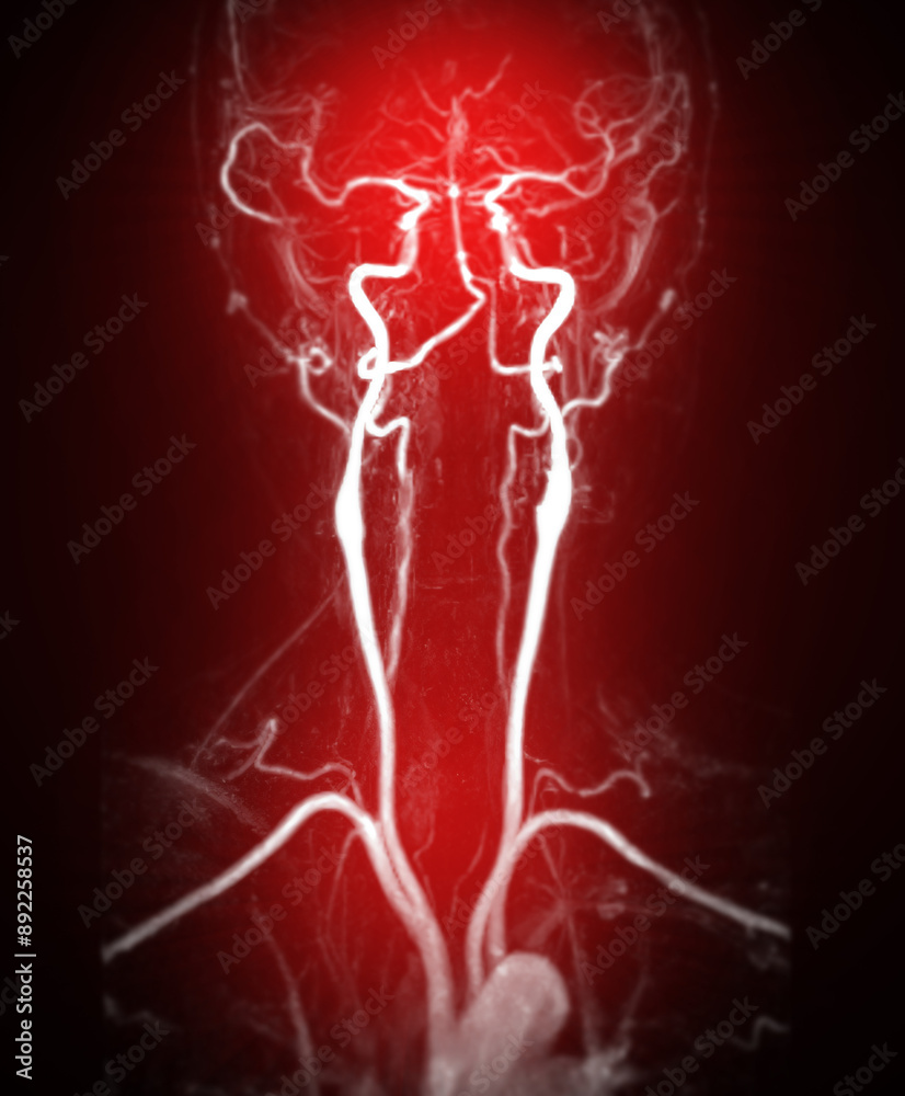 MRA Brain and neck or Magnetic resonance angiography ( MRA ) of ...