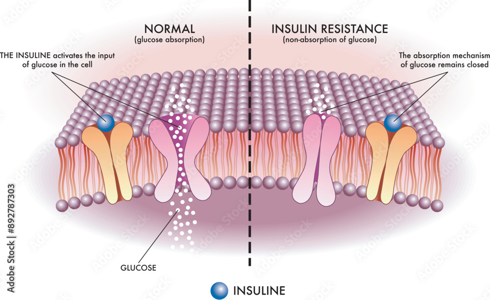 Medical illustration shows in a simple and schematic way the mechanism ...