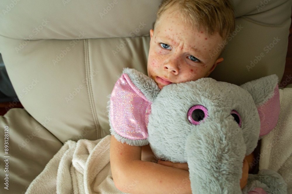 Natural vaccination. Contagious disease. Sick child with chickenpox ...