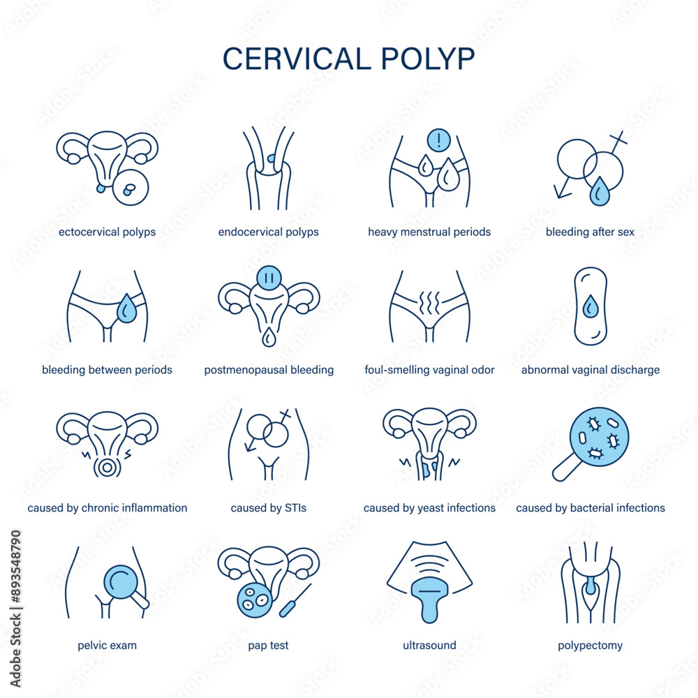 Cervical Polyp symptoms, diagnostic and treatment vector icons. Medical ...