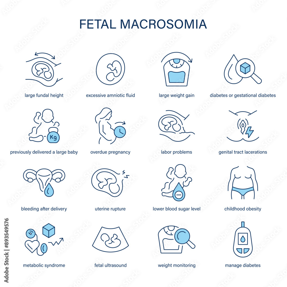 Fetal Macrosomia symptoms, diagnostic and treatment vector icons ...