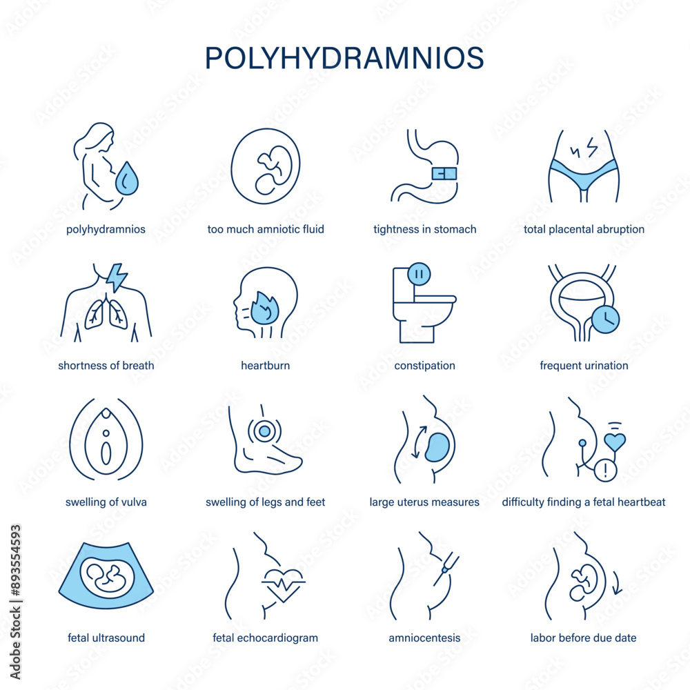 Poster Polyhydramnios symptoms, diagnostic and treatment vector icons ...