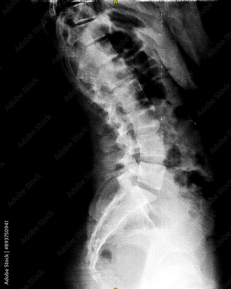 X-ray of lumbar spine and pelvis. Lateral view. Vertebrae and ...