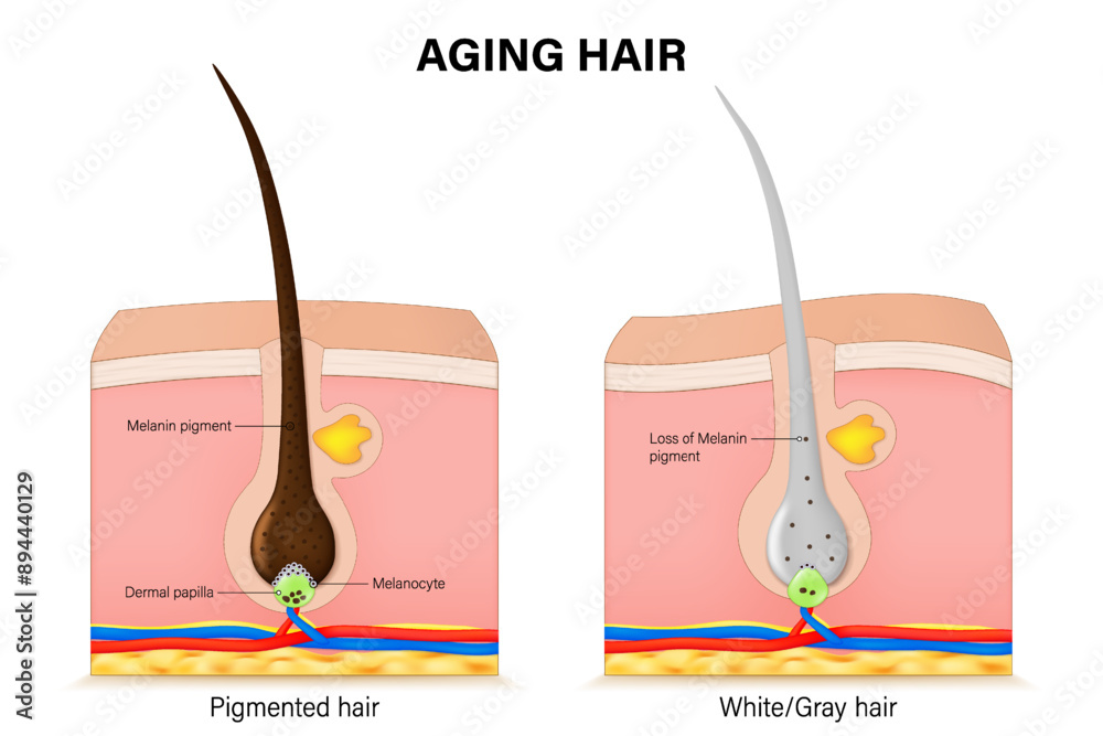 Aging hair. Pigmented and gray hair. Due to increasing age Hair becomes ...