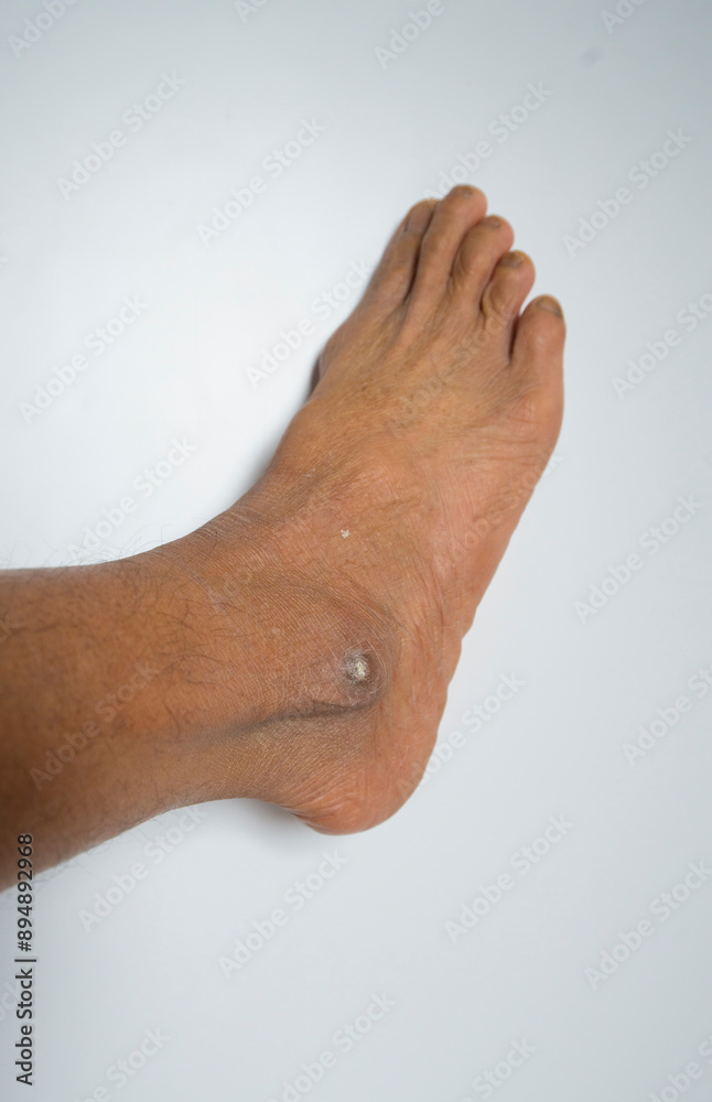 bunions, calluses of hardened skin that look like fish eyes due to ...
