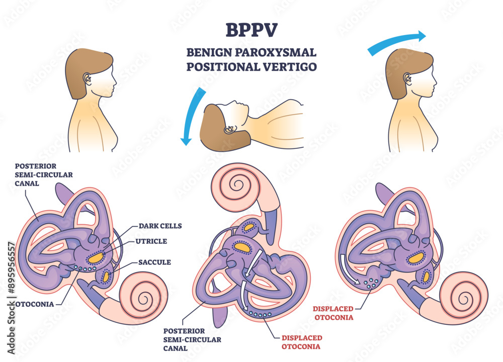 BPPV or benign paroxysmal positional vertigo syndrome outline diagram ...