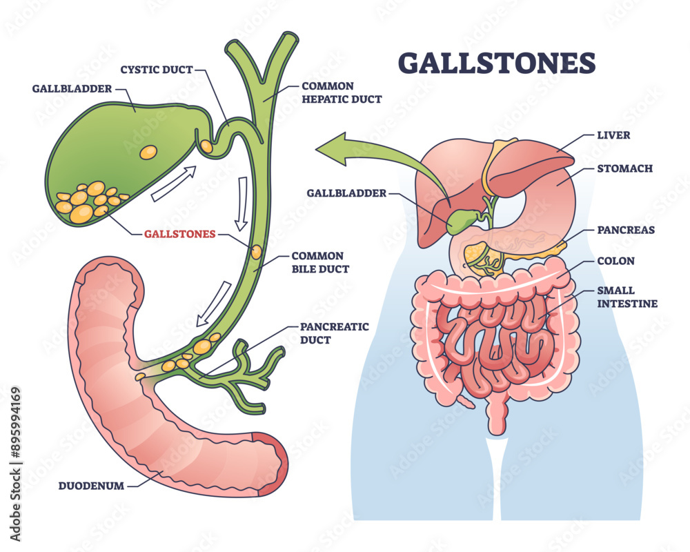 Gallstones as stones of cholesterol in gallbladder outline diagram ...