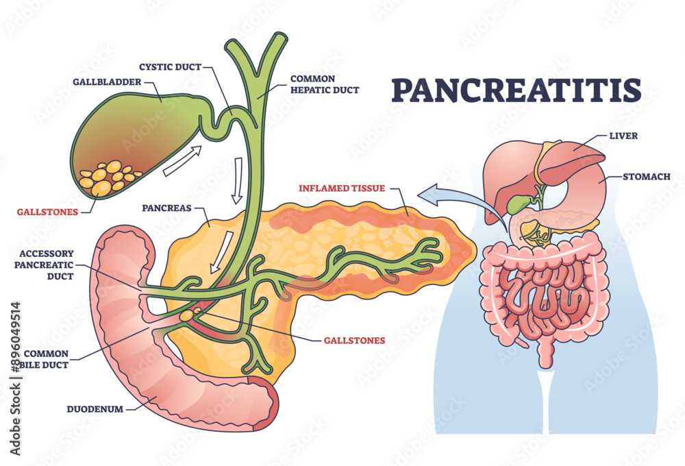 Pancreatitis as pancreas inflammation from chronic or acute gallstones ...