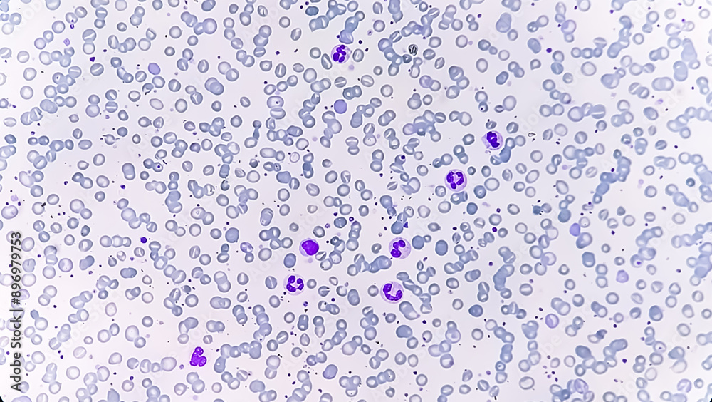 Anisocytosis anisochromia with both microcytic hypochromic and ...