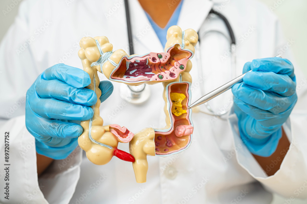 Ulcerative Colitis. Intestine, appendix and digestive system, doctor ...