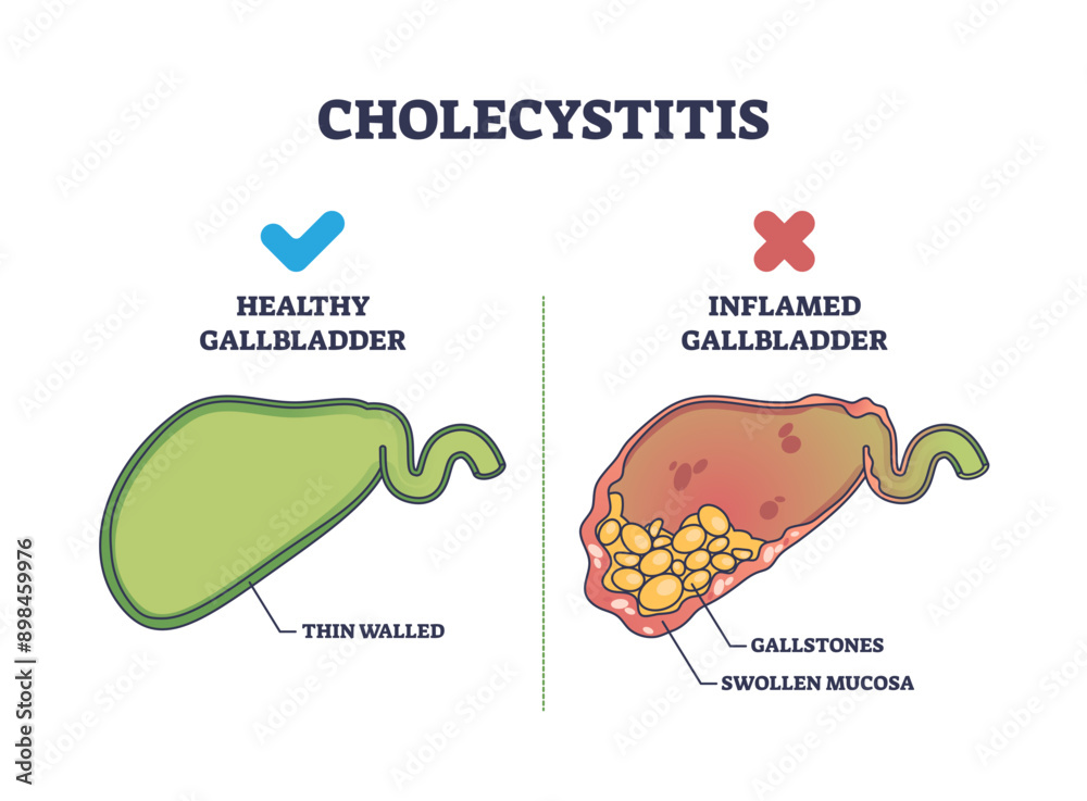 Cholecystitis as inflamed gallbladder compared with healthy outline ...