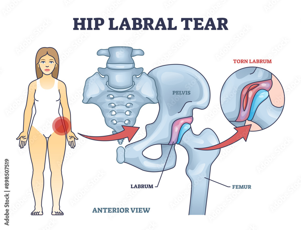 Hip labral tear anatomical explanation with medical labrum bone damage outline diagram ...