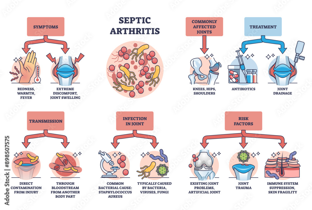 Septic arthritis as joint infection and infection in bone outline ...
