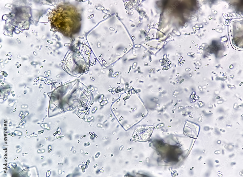 Uric acid crystals and calcium oxalate monohydrate under microscope ...
