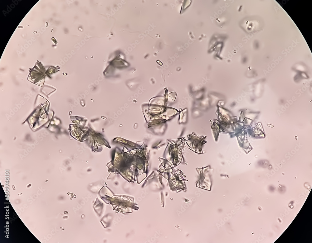 Uric acid crystals and calcium oxalate monohydrate under microscope ...