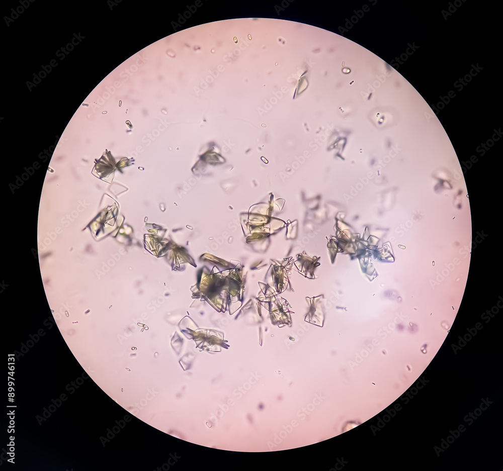 Uric acid crystals and calcium oxalate monohydrate under microscope ...