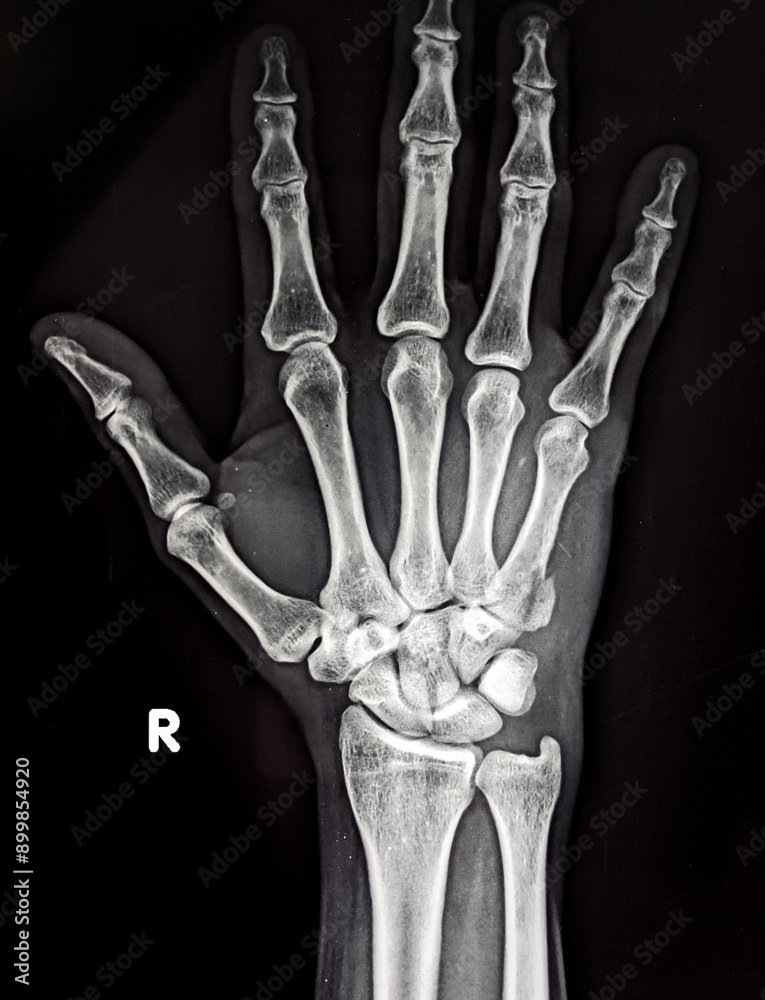 X ray of hand showing fifth metacarpal fracture, a common sports injury ...