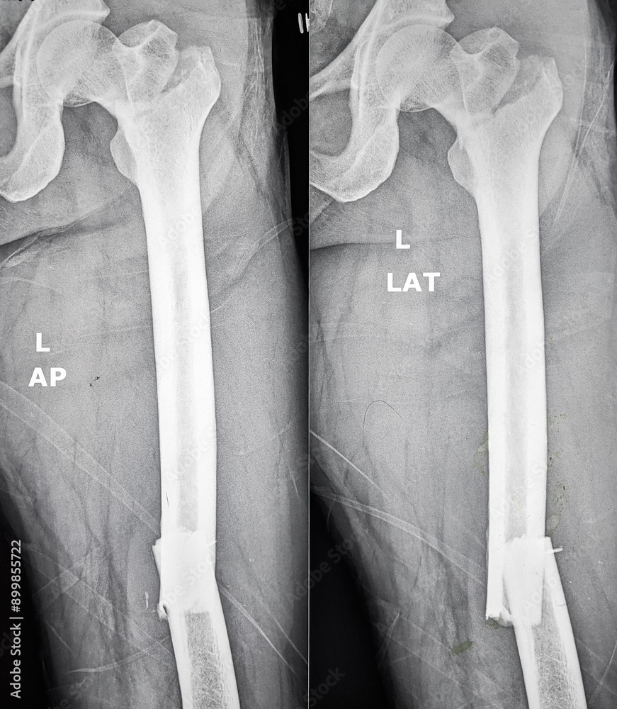 Xray image of femur fracture , intertrochanteric fracture and shaft of ...