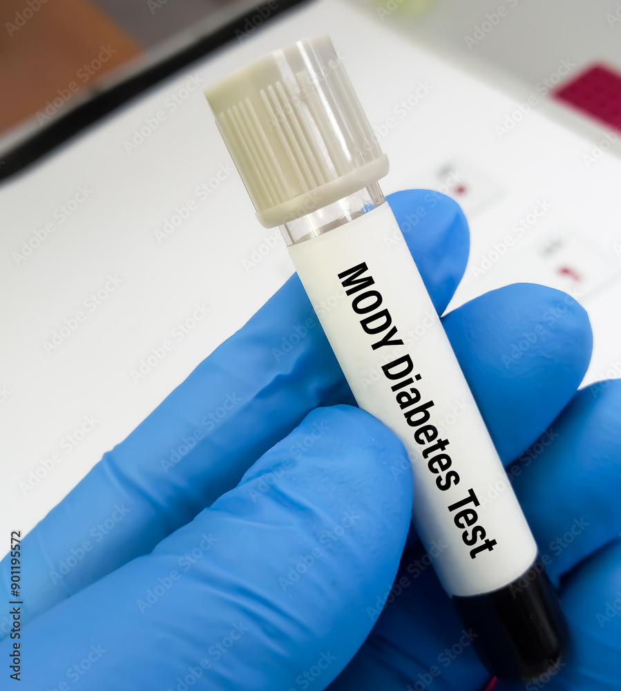 Blood sample for MODY or Maturity-Onset Diabetes of the Young test to ...