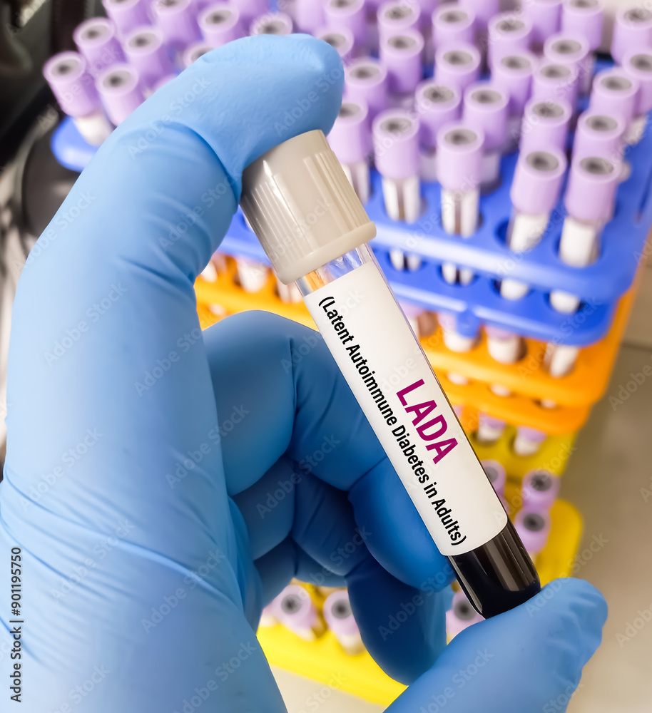 Blood sample for LADA(type-1.5 diabetes) or Latent Autoimmune Diabetes ...