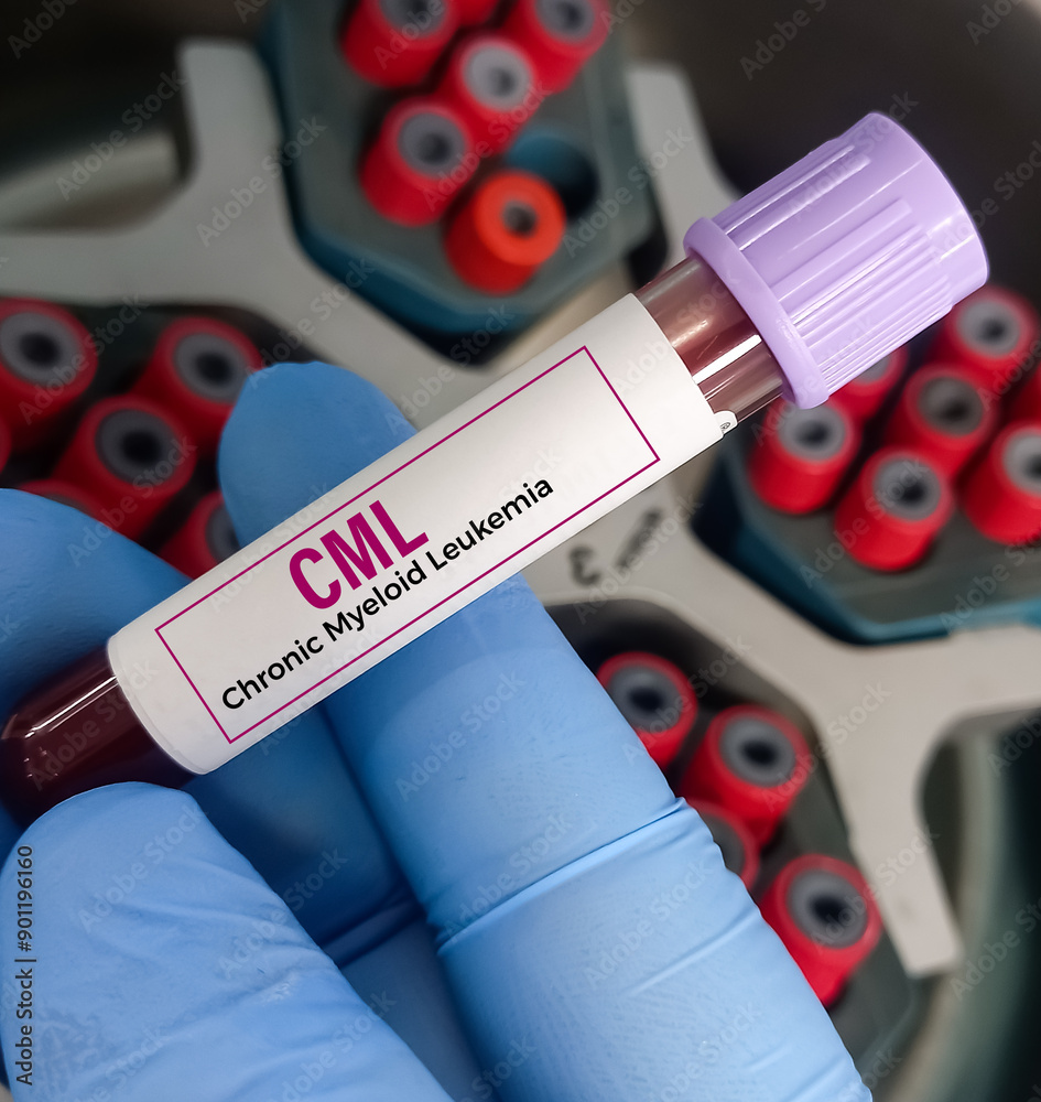 Blood sample for chronic myeloid leukemia (CML) test. It is a rare ...