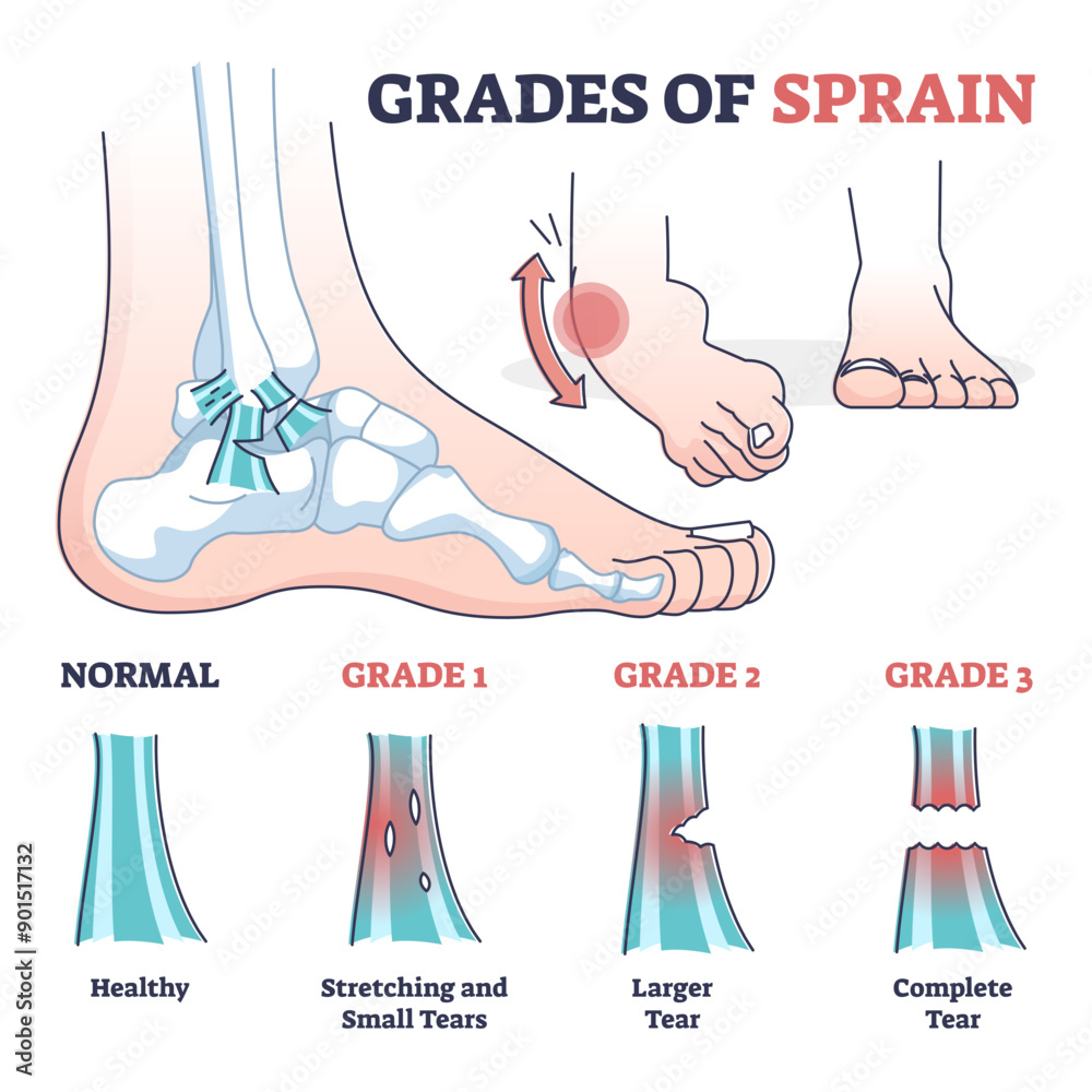 Grades of sprain as ankle or foot medical injury levels outline diagram ...
