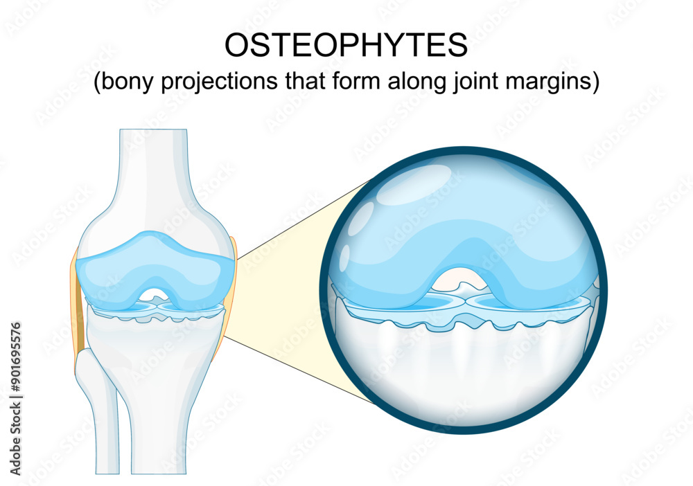 Osteophyte. Anatomy of human knee joint Osteoarthritis Stock Vector ...
