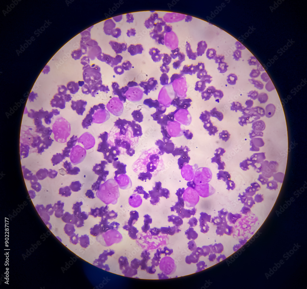 Acute leukemia, ALL(Acute lymphoblastic leukemia), peripheral blood ...
