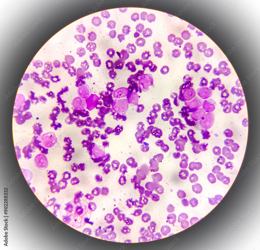 Acute leukemia, ALL(Acute lymphoblastic leukemia), peripheral blood ...