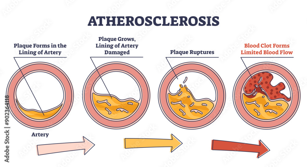 Atherosclerosis stages explanation and fatty plaque formation outline ...